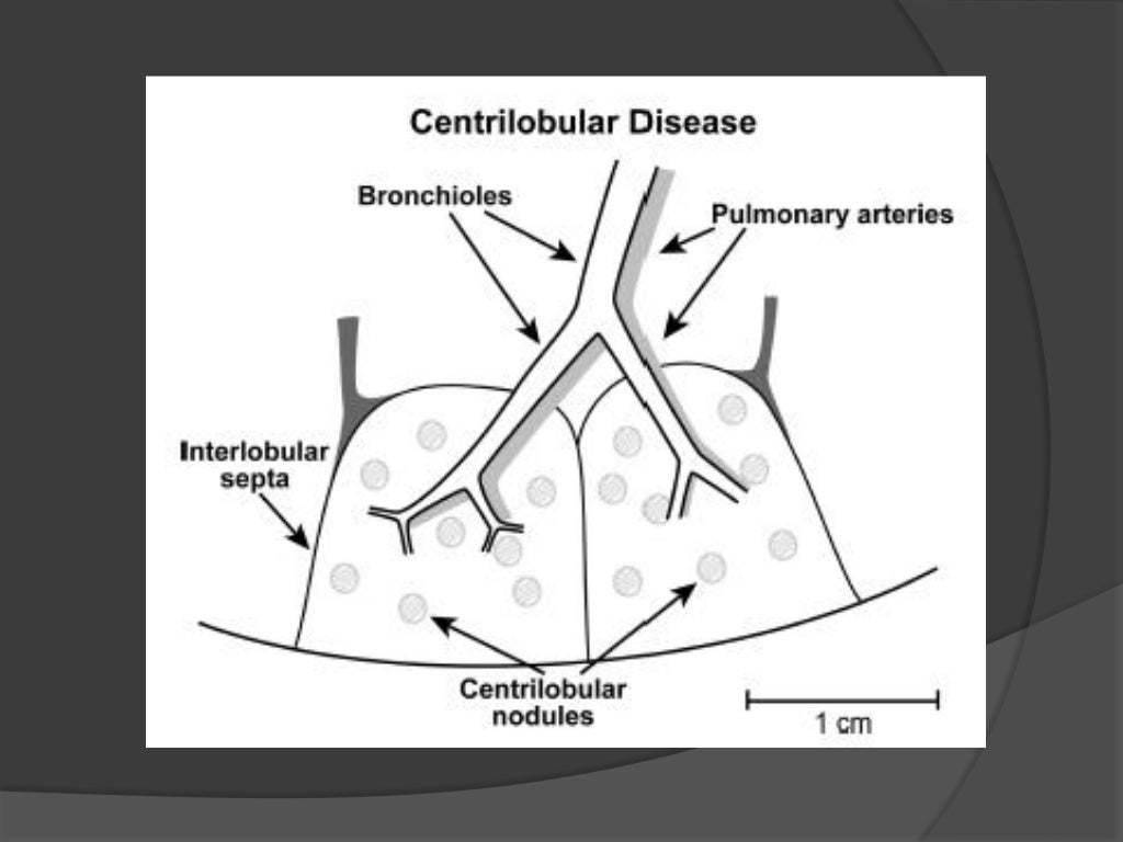 Tac Torax Patron Nodular