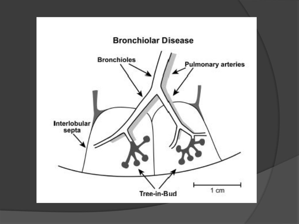 Tac Torax Patron Nodular