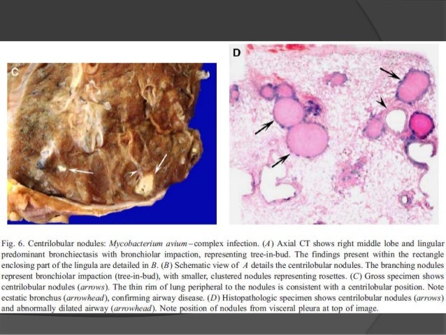 Tac Torax Patron Nodular