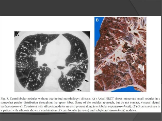 Tac Torax Patron Nodular