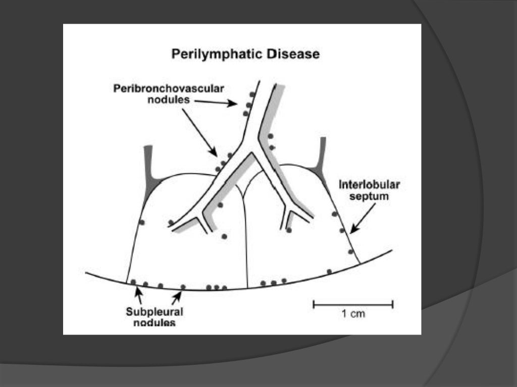 Tac Torax Patron Nodular