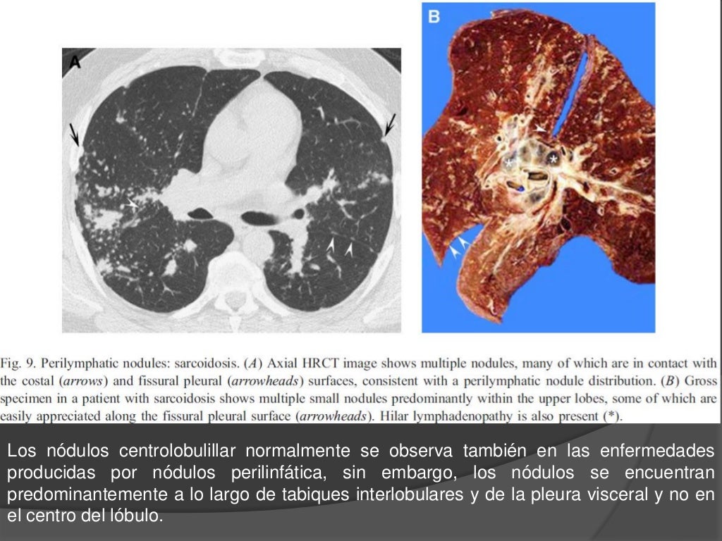 Tac Torax Patron Nodular