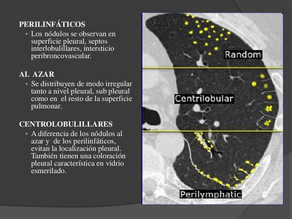 Tac Torax Patron Nodular