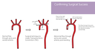 Transverse Aortic Constriction: The Importance of Monitoring Surgical ...