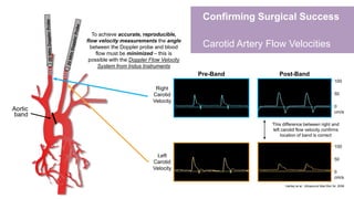 Transverse Aortic Constriction: The Importance of Monitoring Surgical ...