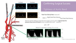Transverse Aortic Constriction: The Importance of Monitoring Surgical ...