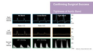 Transverse Aortic Constriction: The Importance of Monitoring Surgical ...