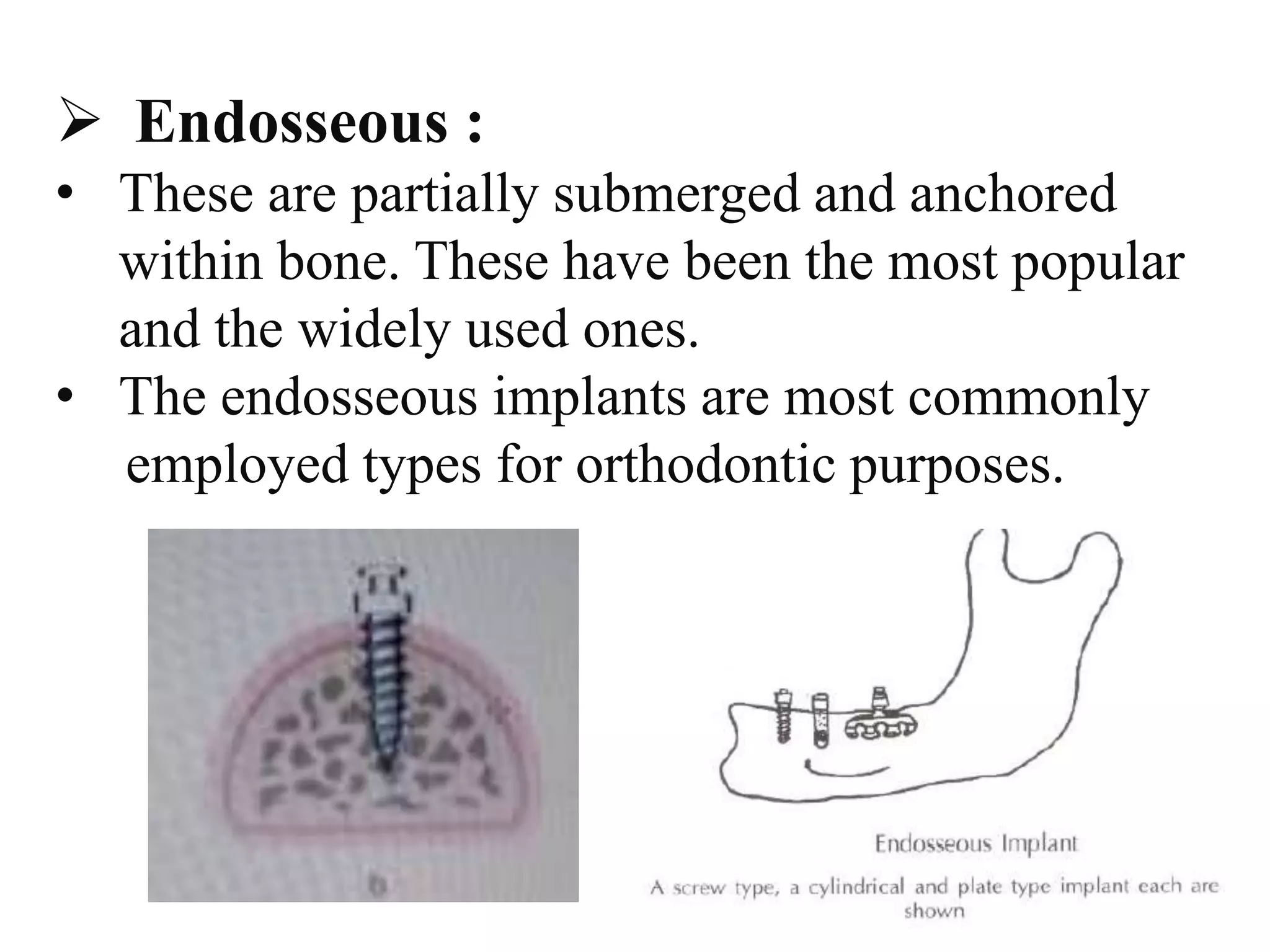 Temporary anchorage devices in orthodontics | PPTX