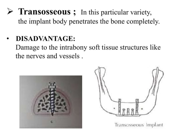 Temporary anchorage devices in orthodontics | PPTX