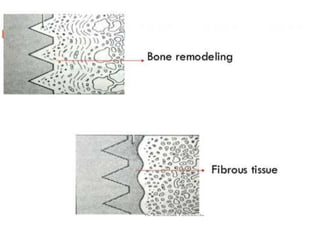 Temporary anchorage devices in orthodontics | PPTX