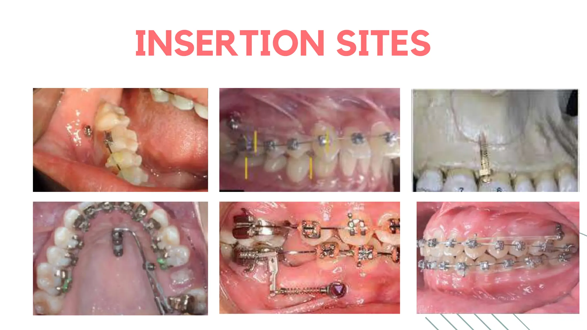 Temporary anchorage devices (TADs) .pptx