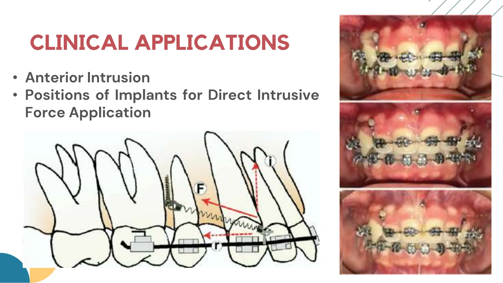 Temporary anchorage devices (TADs) .pptx