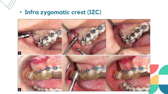 Temporary anchorage devices (TADs) .pptx