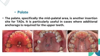 Temporary anchorage devices (TADs) .pptx