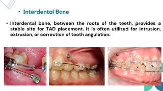 Temporary anchorage devices (TADs) .pptx