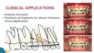 Temporary anchorage devices (TADs) .pptx