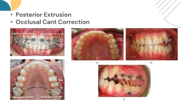 Temporary anchorage devices (TADs) .pptx