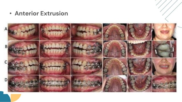 Temporary anchorage devices (TADs) .pptx