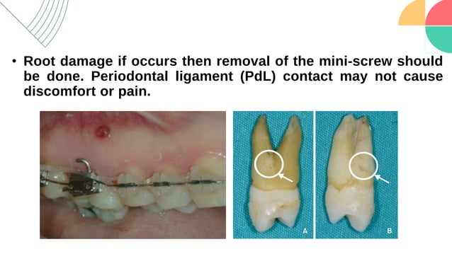 Temporary anchorage devices (TADs) .pptx