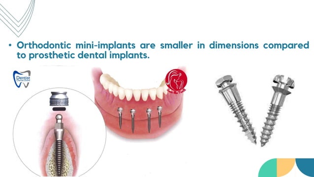 Temporary anchorage devices (TADs) .pptx