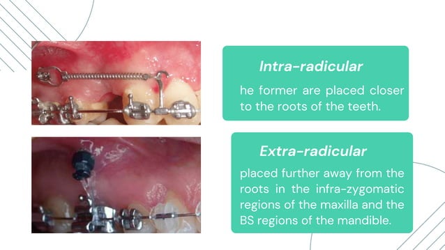 Temporary anchorage devices (TADs) .pptx