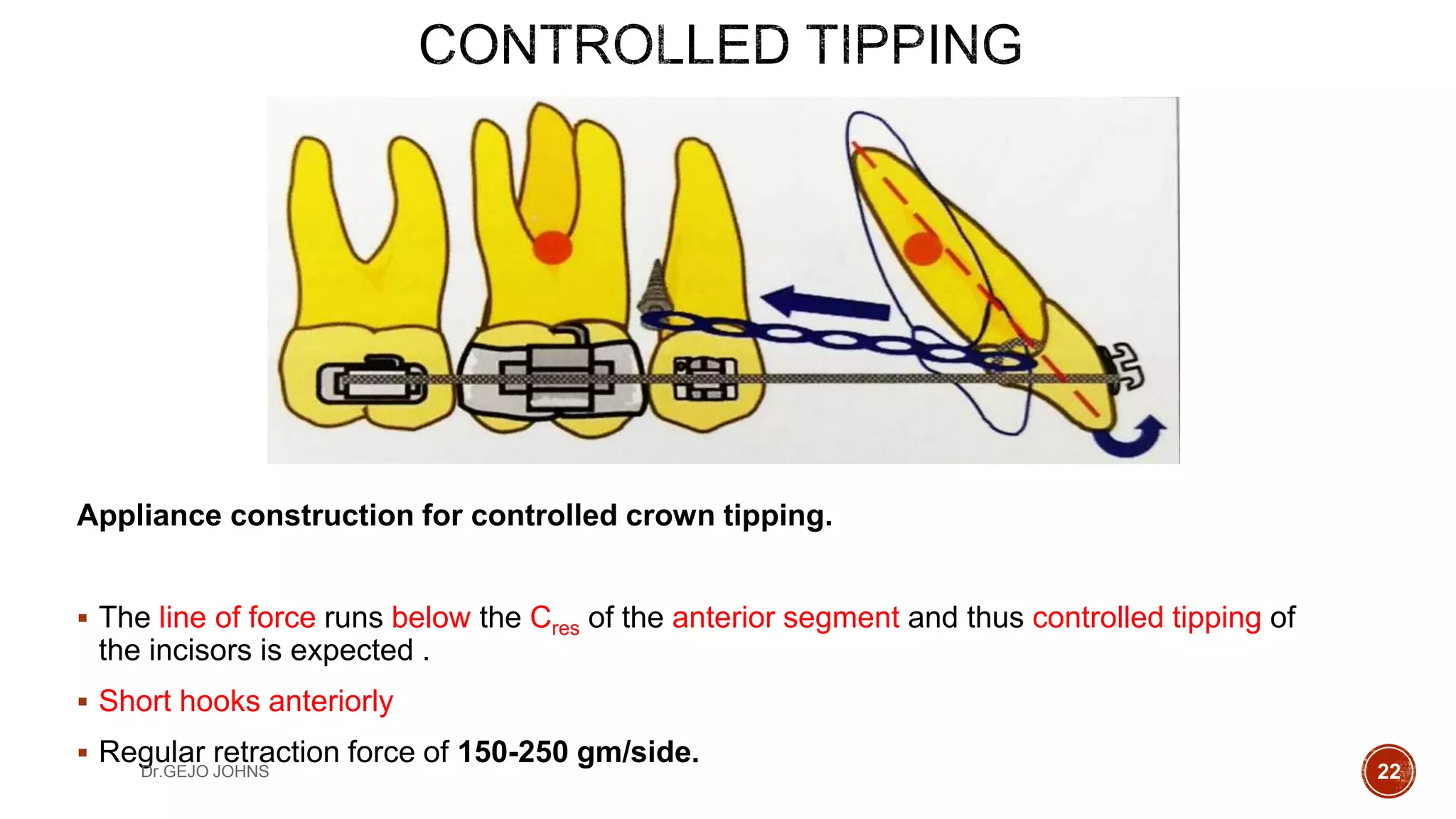 Bio-mechanics of TADS | PPTX