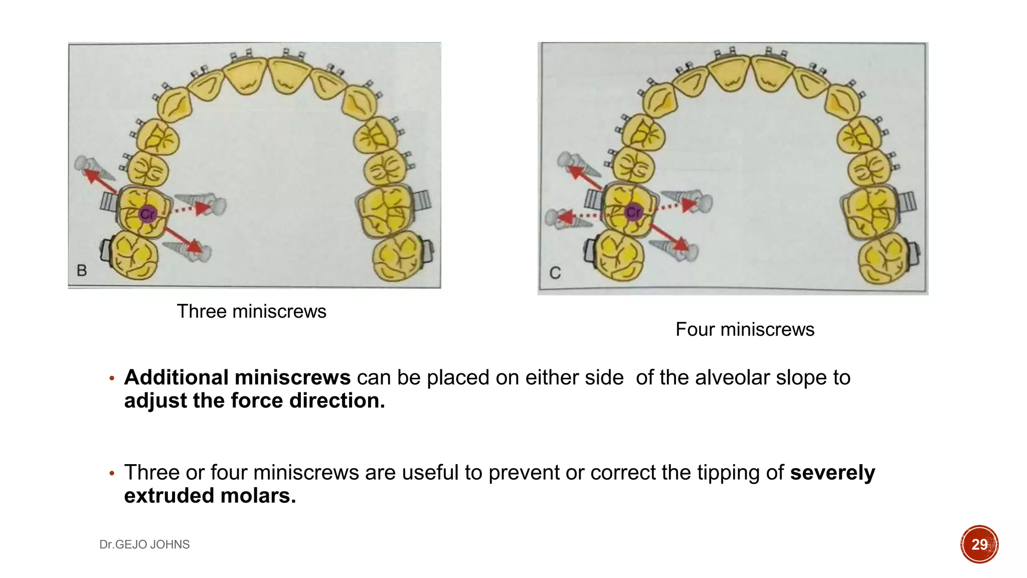 Bio-mechanics of TADS | PPTX