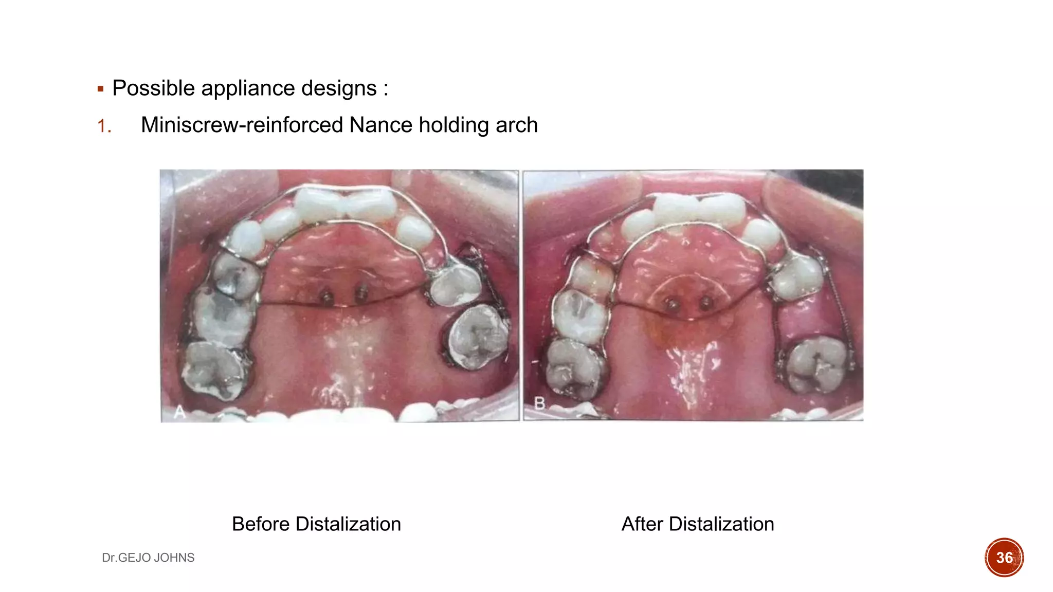 Bio-mechanics of TADS | PPTX