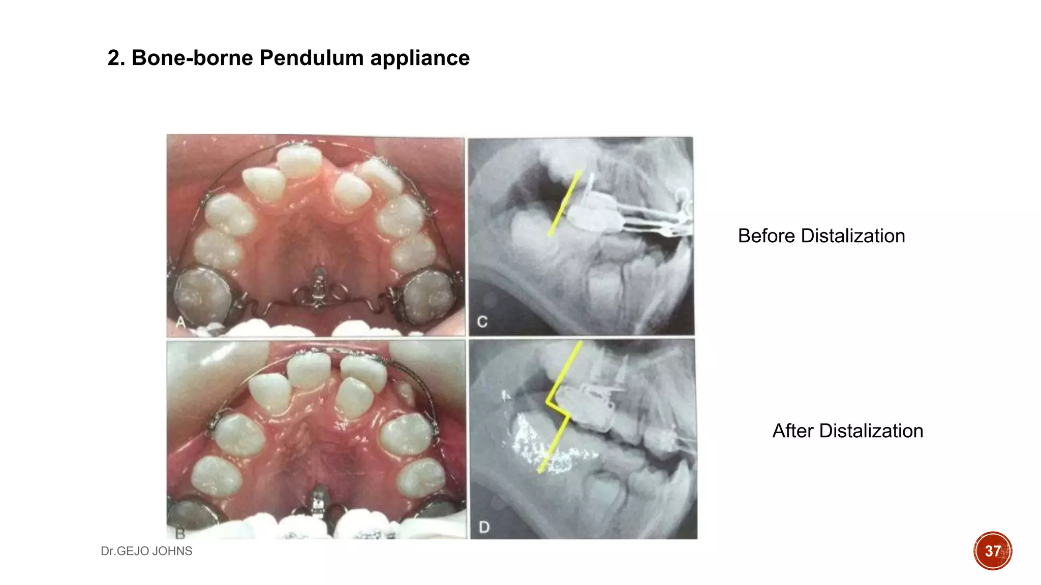 Bio-mechanics of TADS | PPTX