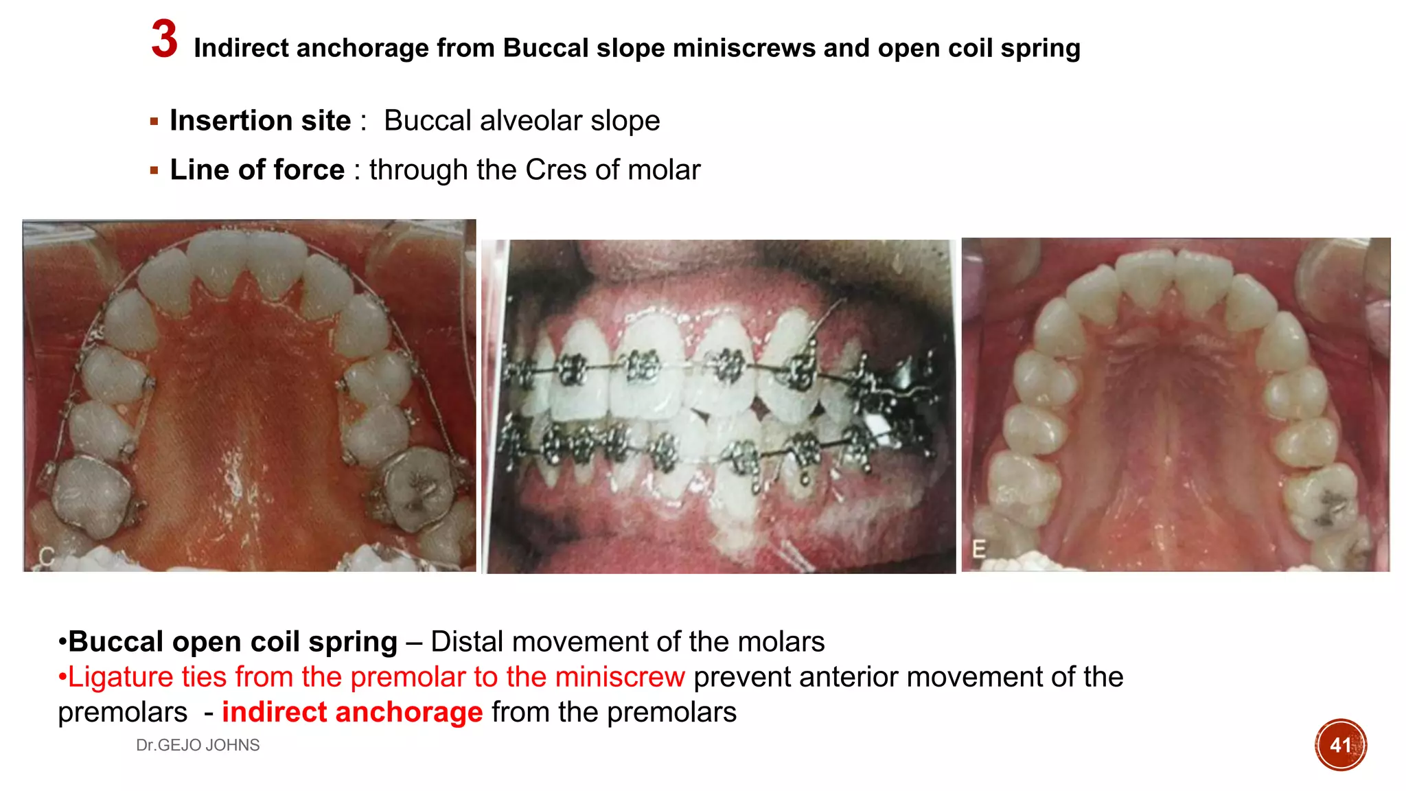 Bio-mechanics of TADS | PPTX