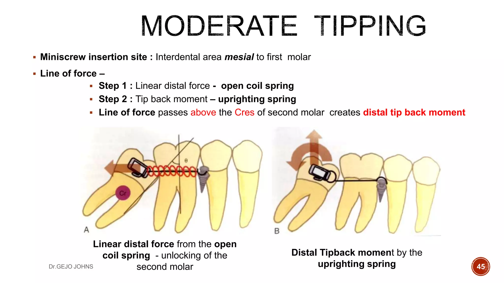 Bio-mechanics of TADS | PPTX