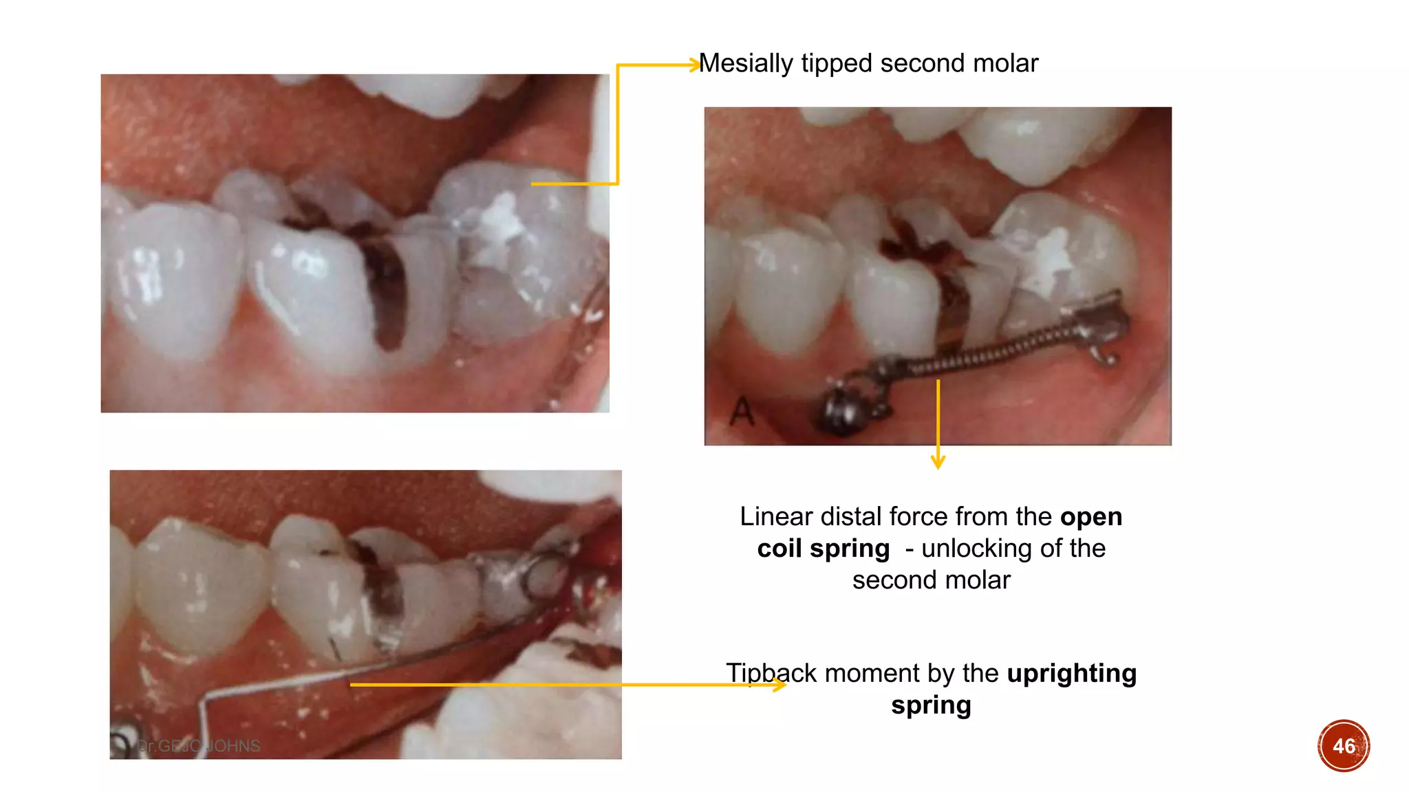 Bio-mechanics of TADS | PPTX