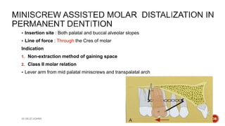 Bio-mechanics of TADS | PPTX