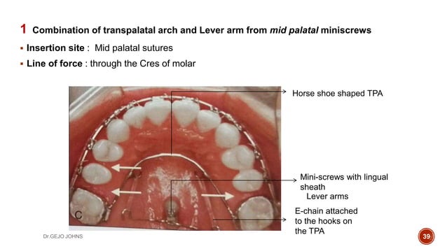 Bio-mechanics of TADS | PPTX