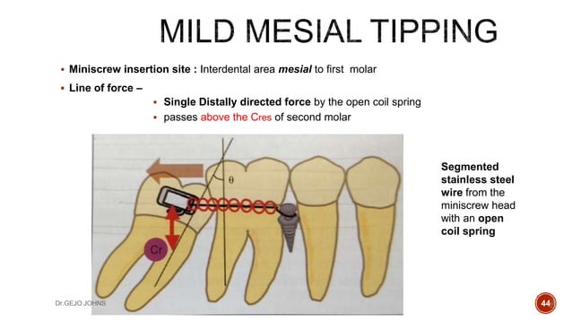 Bio-mechanics of TADS | PPTX