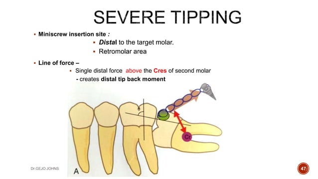 Bio-mechanics of TADS | PPTX