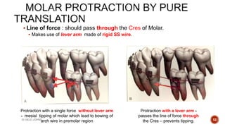Bio-mechanics of TADS | PPTX