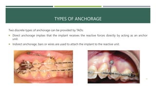 Temporary anchorage device in orthodontics | PPTX