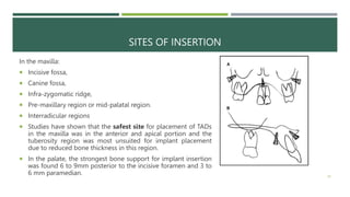 Temporary anchorage device in orthodontics | PPTX