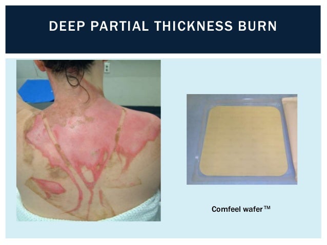 Taggart on burns uncovered then covered 2