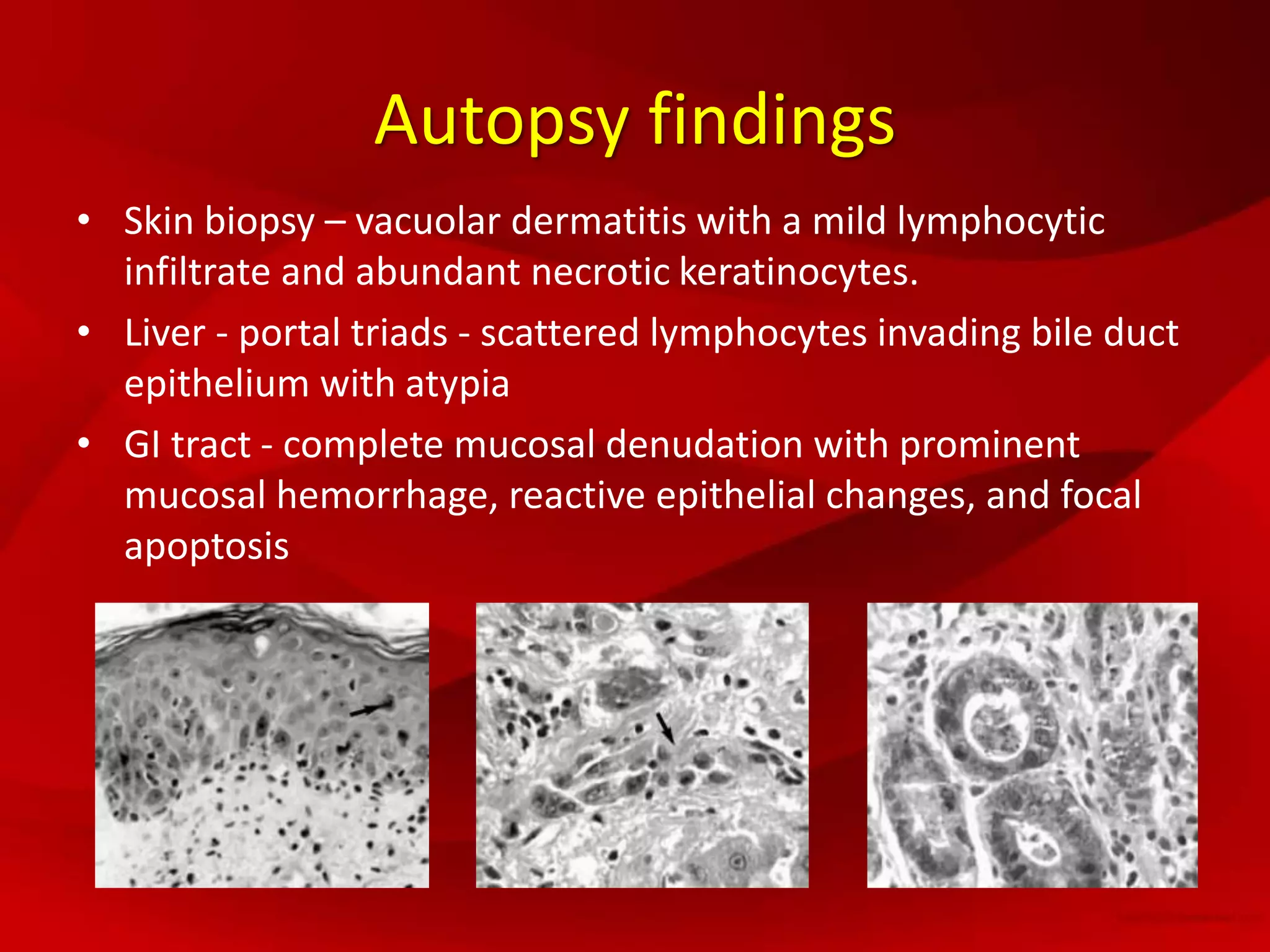 Transfusion associated graft versus host disease | PPTX