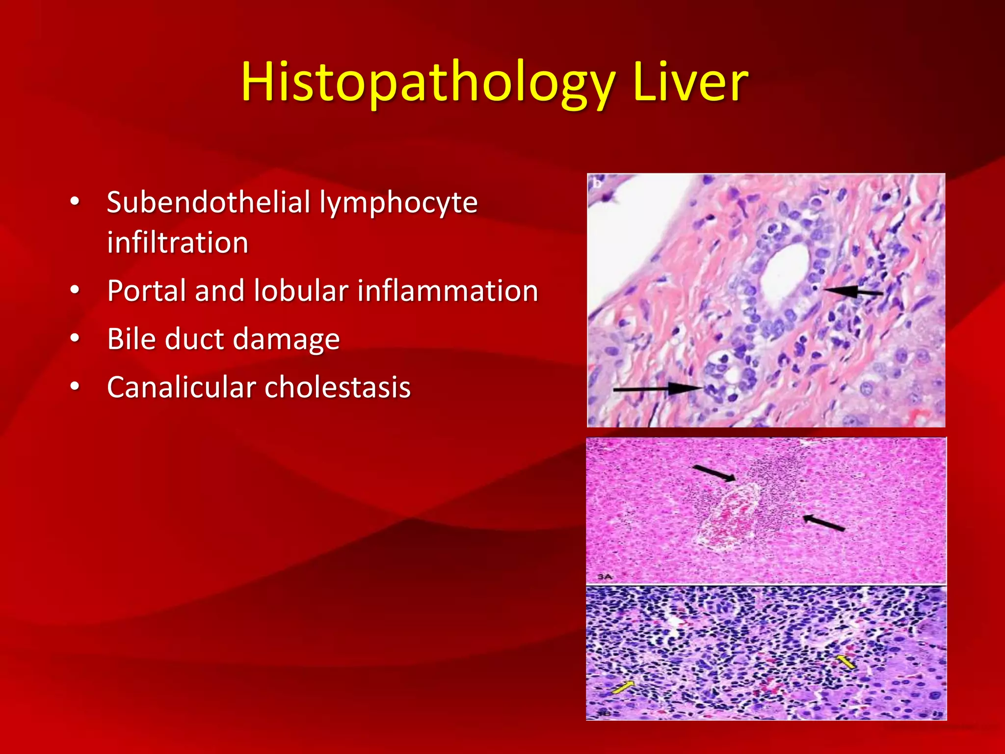 Transfusion associated graft versus host disease | PPTX