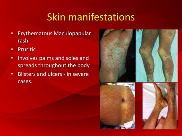 Transfusion associated graft versus host disease | PPTX