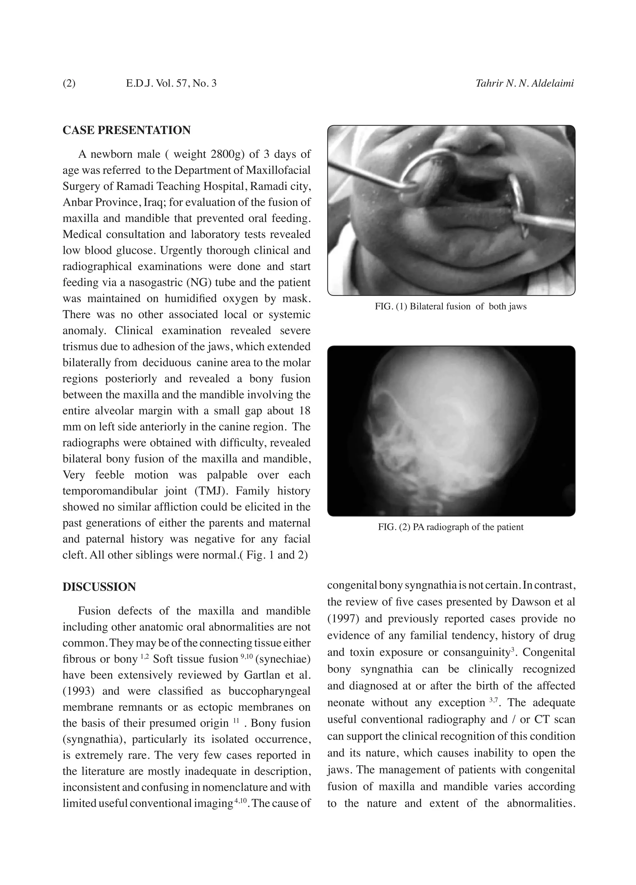 3.Tahrir N. Aldelaimi Article BONY SYNGNATHIA (CONGENITAL FUSION OF ...