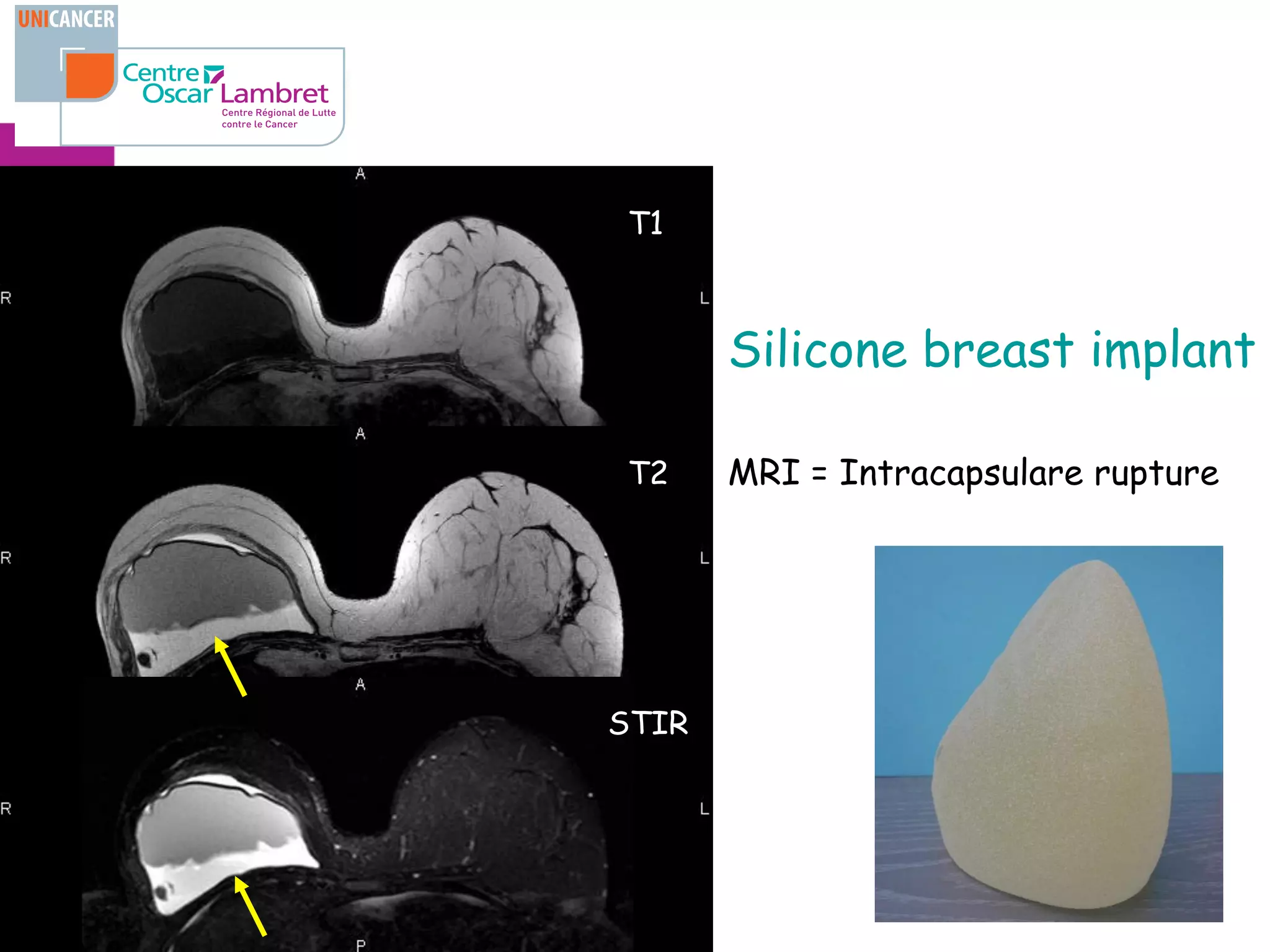 Sophie Taieb : Breast MRI indication 2014 | PDF