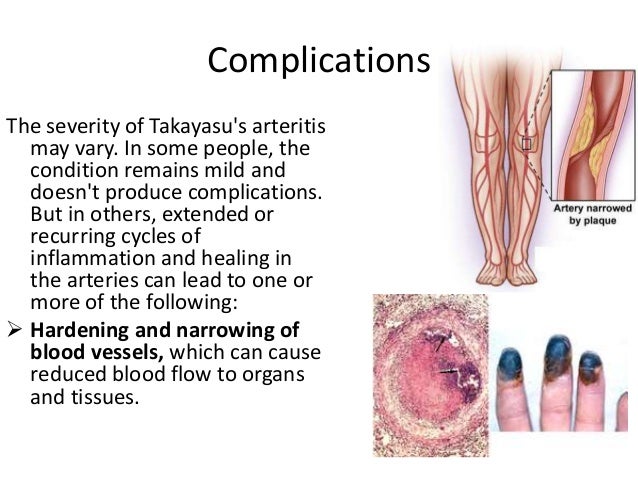 Takayasu arteritis