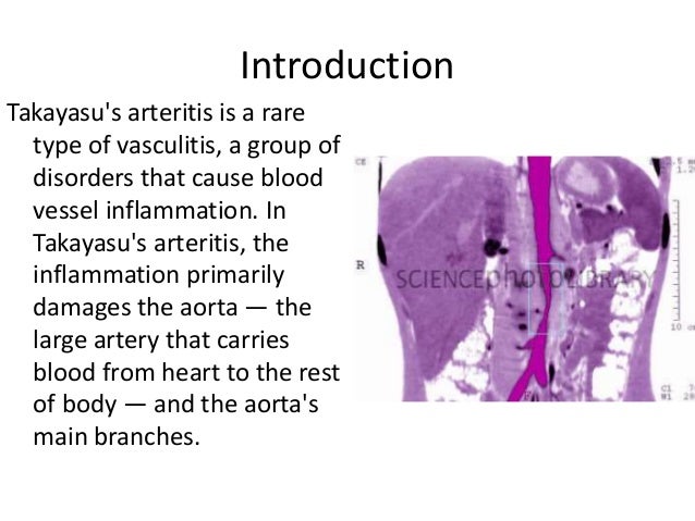 Takayasu arteritis