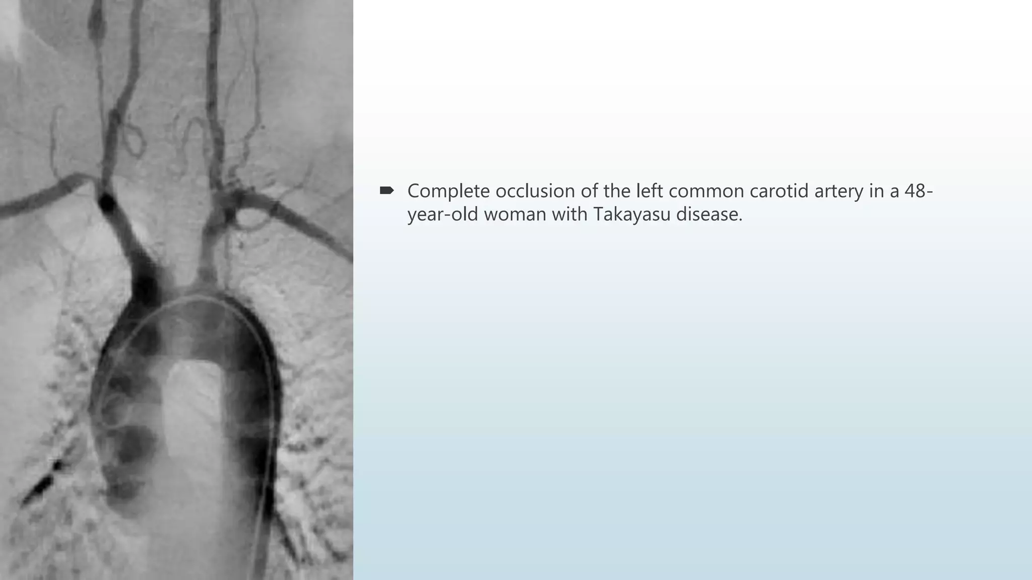 Takayasu arteritis –anatomy, classification physical examination | PPTX ...