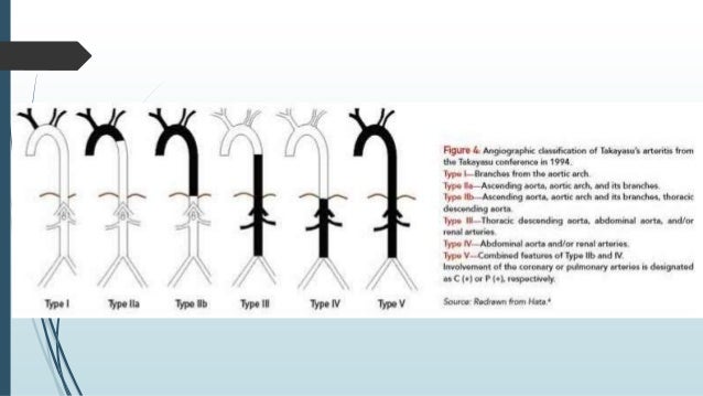 Takayasu arteritis –anatomy, classification physical examination