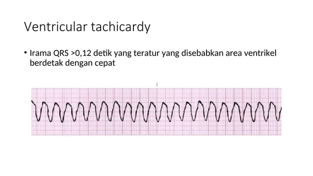 penanganan kasus TAKIKARDIA berdasarkan .ppt